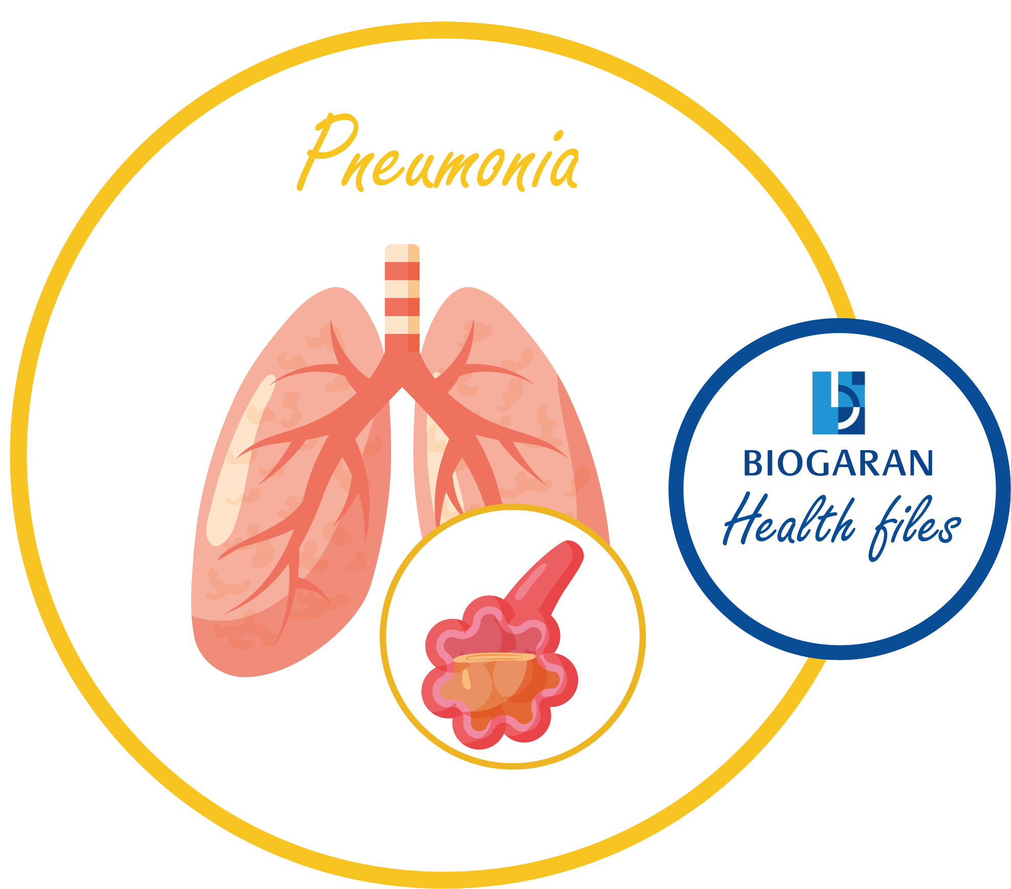 Respiratory infections #2: Pneumonia
